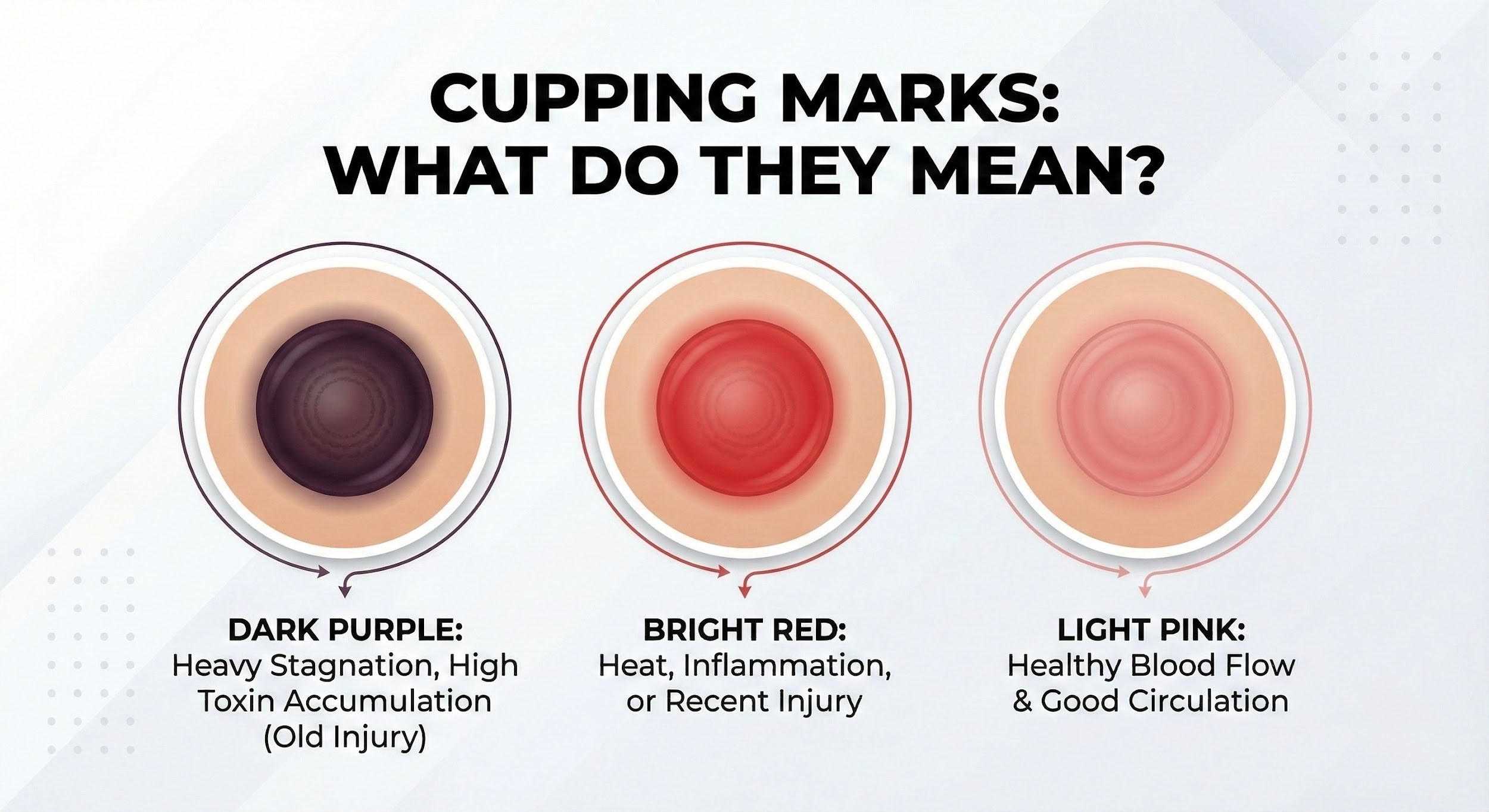 Cupping Therapy Cedar Hill: What are Those Red Circles?